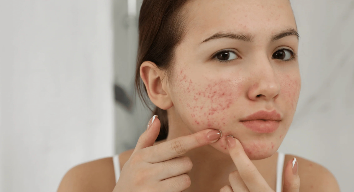 Ultimate Guide to Acne Types by Grade: Identify & Treat Fast