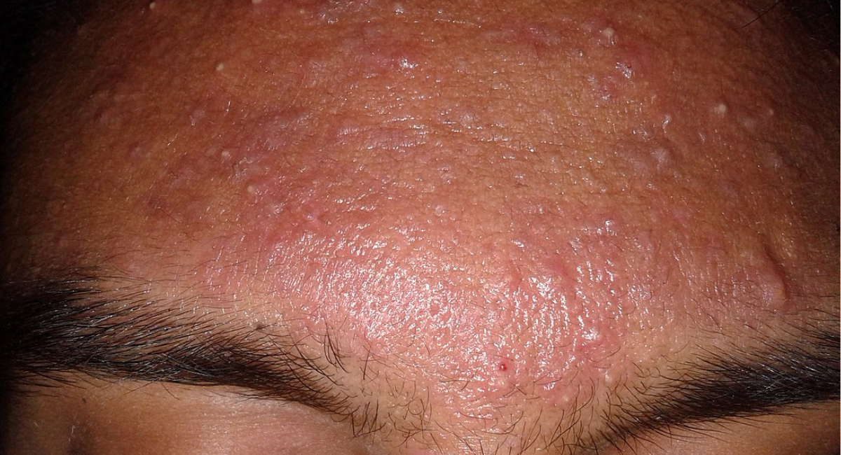 Ultimate Guide to Acne Types by Grade: Identify & Treat Fast