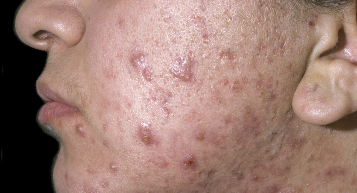 Ultimate Guide to Acne Types by Grade: Identify & Treat Fast