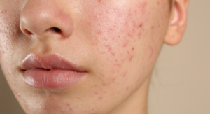 Ultimate Guide to Acne Types by Grade: Identify & Treat Fast